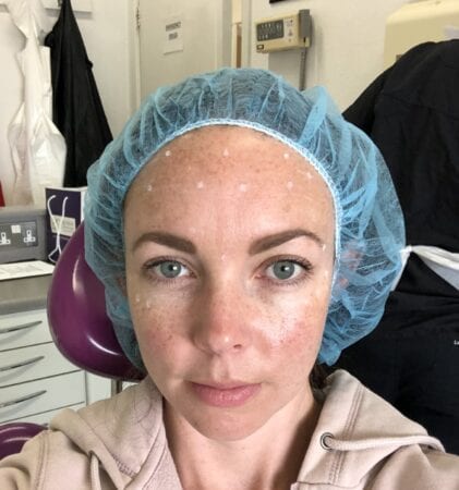 Botox Before and After: Unfiltered Photos + Honest Review